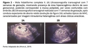 Principais Questões sobre quando suspeitar de Mola Hidatiforme