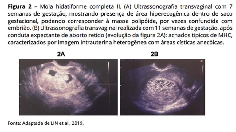 Principais Questões sobre quando suspeitar de Mola Hidatiforme